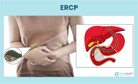 Ercp Test Procedure Steps Complications Recovery Time