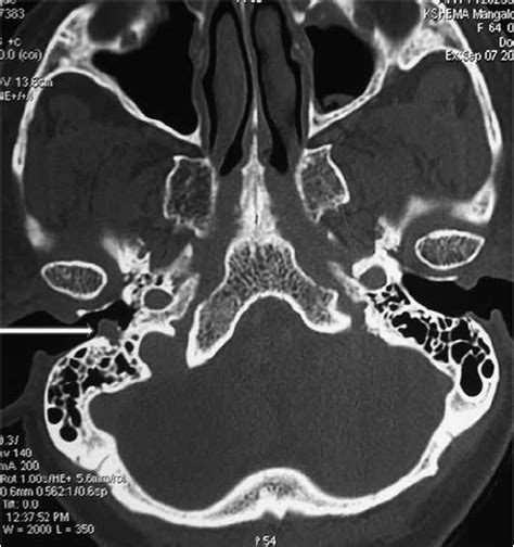 High Resolution Computed Tomography Scan Of The Temporal Bone Scan Of A Download Scientific