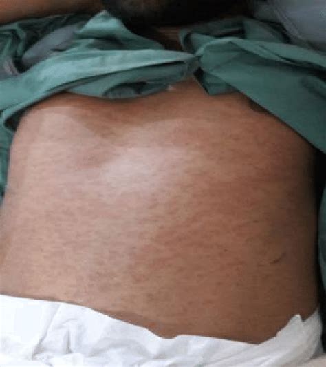 Maculopapular Rashes On The Trunk Download Scientific Diagram