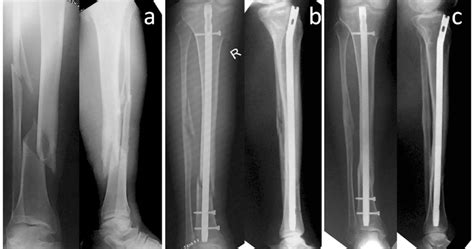 A Patient Treated With Imn A Pre Operative B Early Post Operative A Patient Treated With Imn A Pre Operative B Early Post Operative