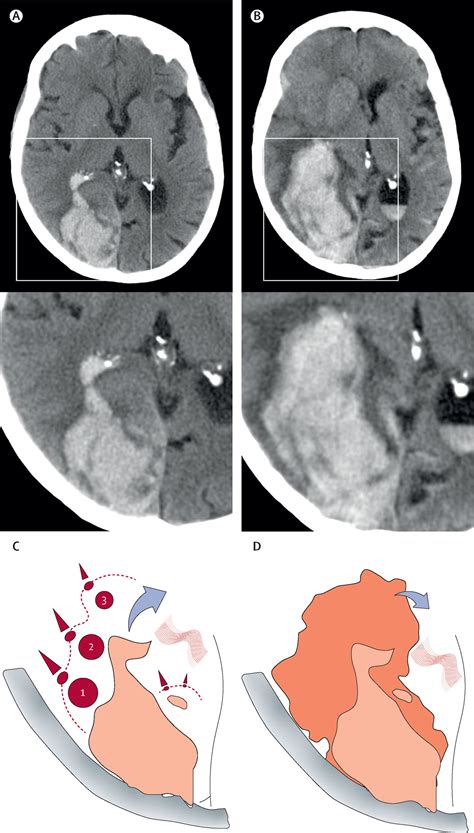Intracerebral Hemorrhage Locations