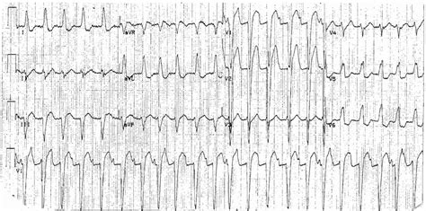 Ecg Case 130 Atrial Flutter With 2 1 Conduction And Rbbb Manual Of Medicine
