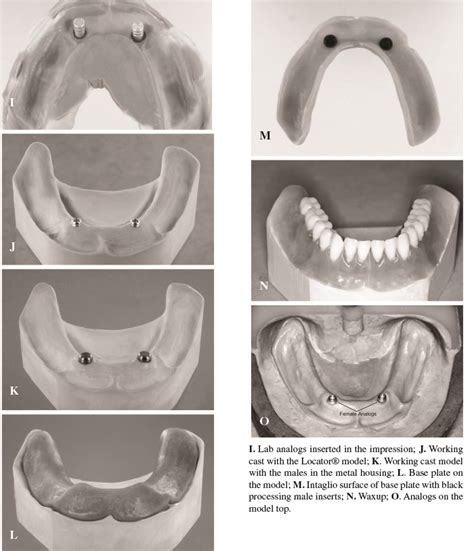 Principles Of Attachment Selection For Implant Supported Overdentures