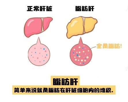 没想到你竟是这样的脂肪肝 健康 资讯 河南商报网