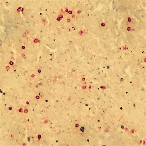 A A Caseating Granuloma Outlined By Arrows H And E ×10 B
