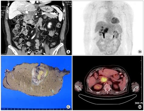 A Abdominal Computed Tomography Ct Revealed The Necrotic