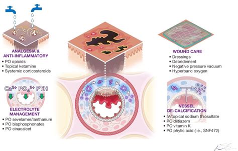 Pathophysiology And Management Of Calciphylaxis A Graphic