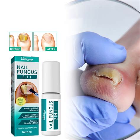 Finger Nail Fungus Ointment At Xavier Guerard Blog