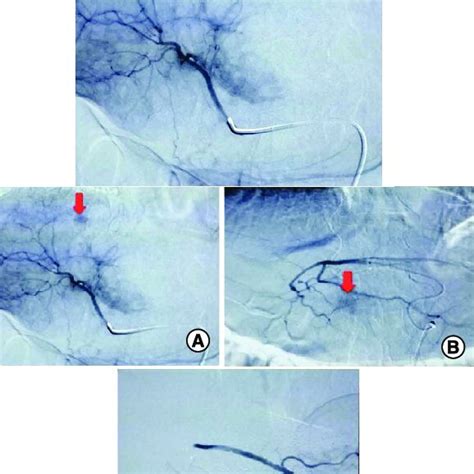 Hepatic Arteriogram With Selective Catheterization Of The Right Hepatic Download Scientific