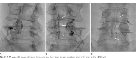 Figure 1 From Fluoroscopy Guided Intra Articular Facet Joint Steroid Injection For The