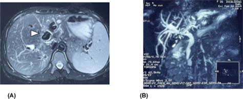 Left Lateral Sectionectomy With Intrahepatic Cholangiojejunostomy For