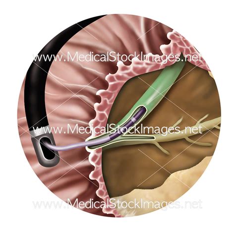Endoscopic Retrograde Cholangiopancreatography Or Ercp Medical Stock