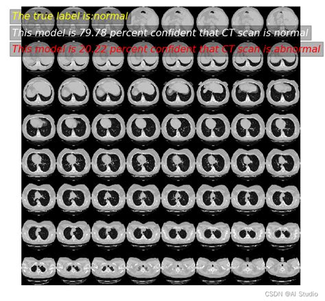 mosmeddata 新冠肺炎胸部 ct扫描数据集上基于3d cnn实现二分类 3d医学影像二分类网络 csdn博客
