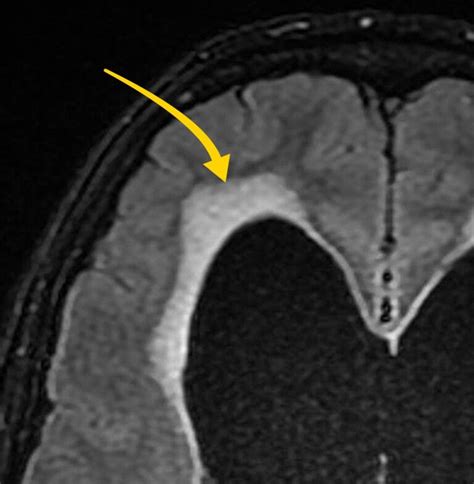 Colloid Cyst The Radiologist