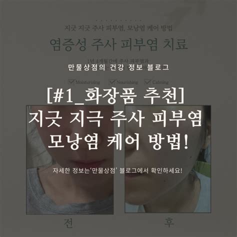 건강 정보•효능 광고 없는😣 극 사실주의 얼굴 주사 피부염 몸 모낭염 박멸 후기 1년 4개월 험난한 치료 과정 주사 피부염 완치1편 네이버 블로그