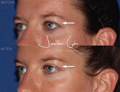 Brow Lifts And Botox Dr Jonathan Cabin Facial Rejuvenation