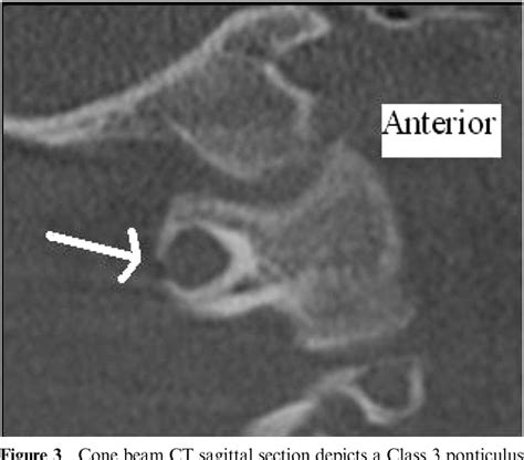 Ponticulus Of Left Auricular Cartilage Semantic Scholar