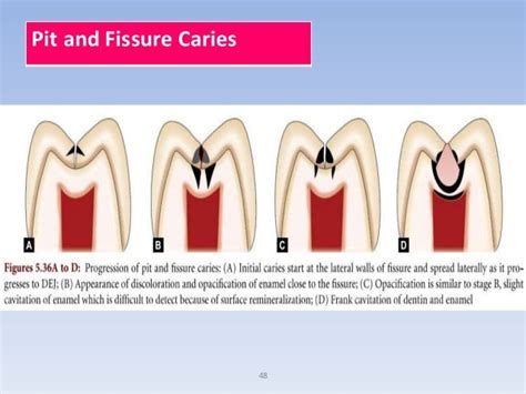 2dental Caries