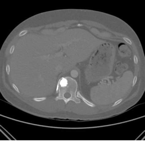 A Chest Ct Scan Performed After The Thoracotomy And Wedge Resection Download Scientific Diagram