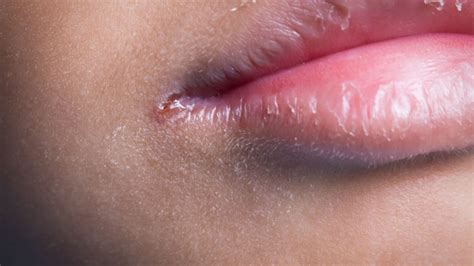 Queilitis Angular Causas Y Tratamiento Efectivo