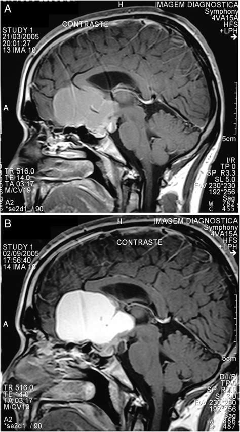 Ten Year Follow Up Of A Giant Prolactinoma Bmj Case Reports