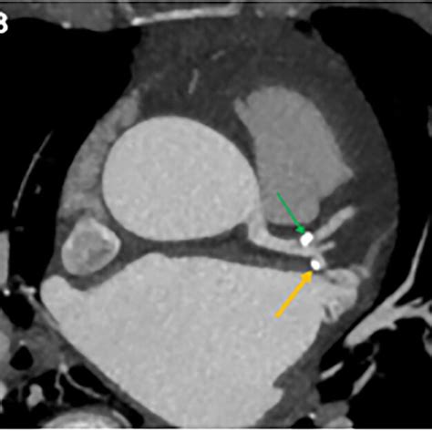 Measurement Of LAD LCX Angle A Measurement Without Ramus Intermedius Download Scientific