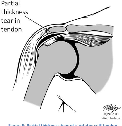 Figure 1 From A Patient Guide To Failed Rotator Cuff Repairs Semantic Scholar