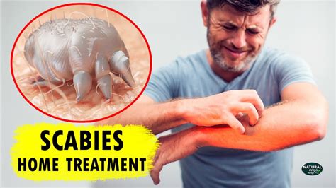 Scabies Treatment And Prevention