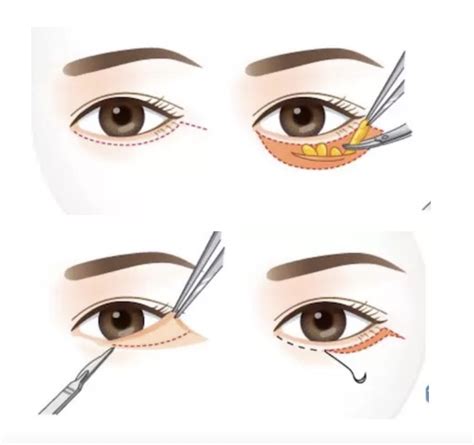 Eyelid Correction Dr Karl Waked Plastic Surgeon