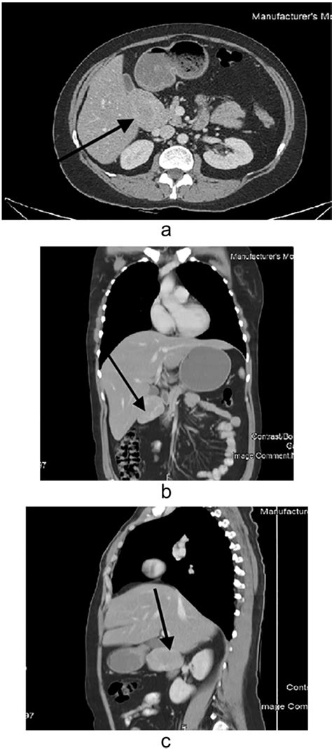 A Ct Scan Axial View With Arrow Pointing To The Para Duodenal Mass B Download Scientific