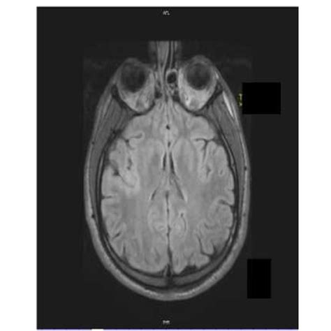 Ictal Scalp Eeg A Left Temporal Seizure Pattern Appeared Up To 50 S Download Scientific