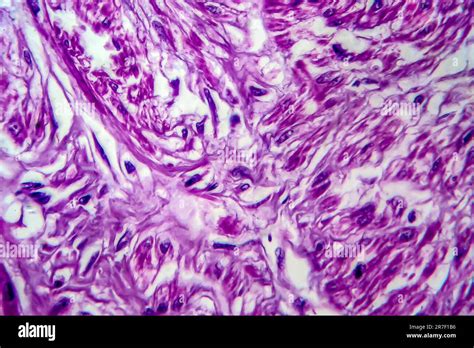 Uterine Fibroid Light Micrograph Lm Of A Section Through Tissue From