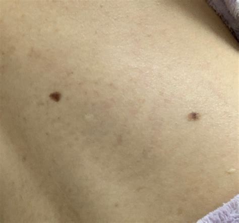 피부암 점 지식in