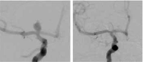 Illustration Demonstrating Embolization Coils Download Scientific Diagram