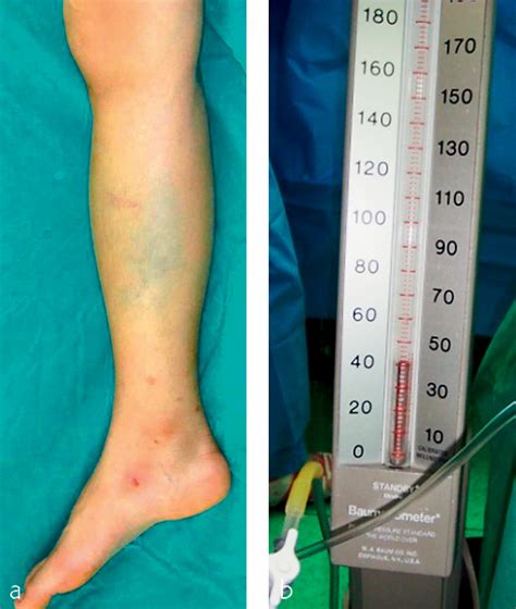 Tibia And Fibula Shaft Simple Fracture Oblique Musculoskeletal Key