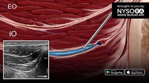 Ultrasoundguided Femoral Nerve Block Nysora