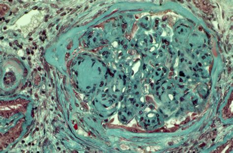 Nodular Glomerulosclerosis In Diabetes Light Micrograph Stock Image C061 2144 Science