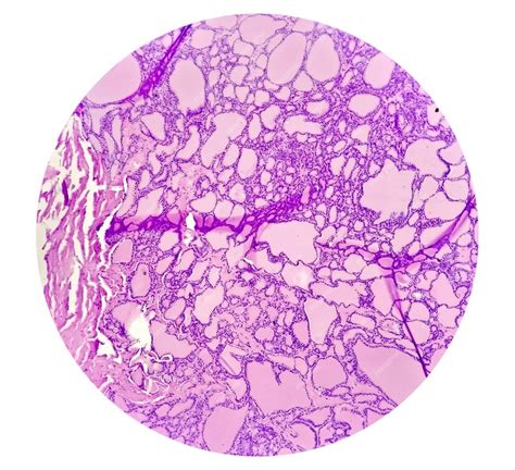 Premium Photo Synovial Sarcoma Histology Image Analyzed By Microscope At Histopathology
