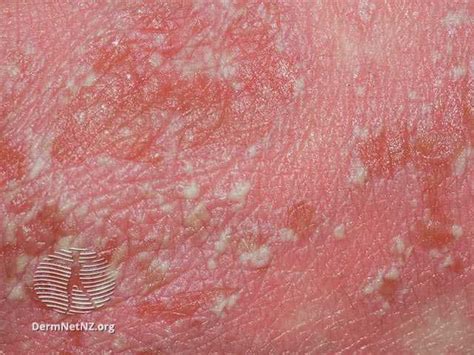 Whats Inside Ipcs New Consensus Statement On Gpp Tdd Talks To Ipcs Chief Medical Officer Dr