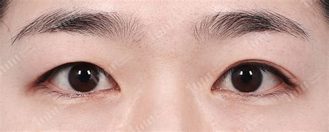 절개 쌍꺼풀 1mm성형외과