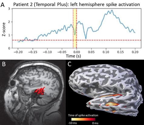 Spatiotemporal Propagation Of Magnetographic Interictal Spikes In