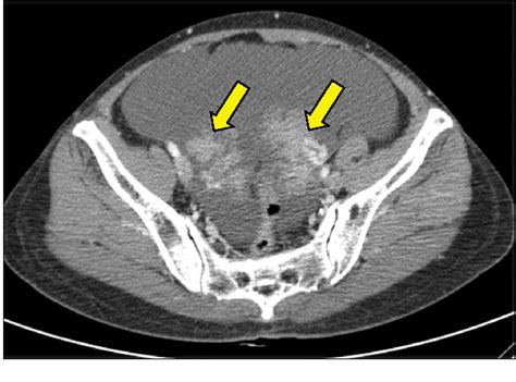Resectable Cholangiocarcinoma Semantic Scholar Resectable Cholangiocarcinoma Semantic Scholar