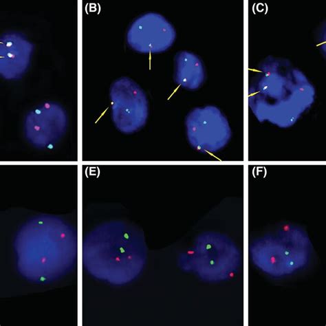 Fish Validation Of Fusion Genes Detected By Rna Sequencing Rna‐seq