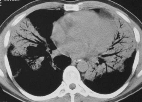 Pulmonary Chest X Ray And CT And V Q Scan Flashcards Quizlet