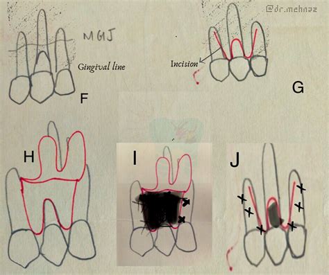 TECHNIQUES TO INCREASE ATTACHED GINGIVA ROOT COVERAGE Dentowesome
