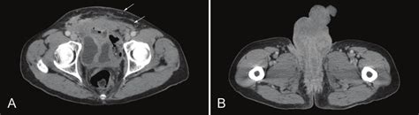 Axial Ct Of The Pelvis A Showing Densification Of Adipose Tissue And