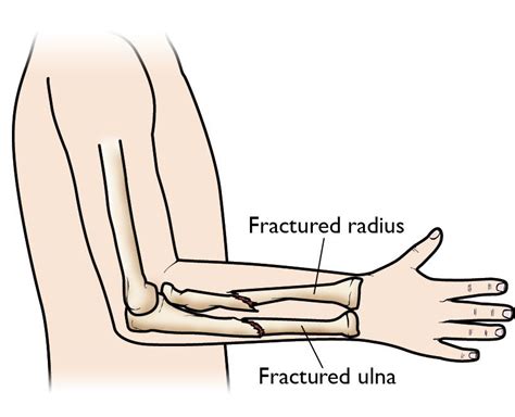 Ulna Bone Fracture