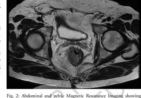 Figure 2 From Surgical Management Of Rectal Gist Semantic Scholar