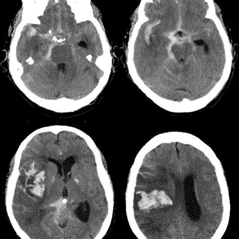 Computed Tomography Revealed Diffuse Subarachnoid Hemorrhage Associated Download Scientific