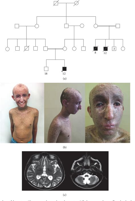 Xeroderma Pigmentosum Causes Signs Symptoms Diagnosis